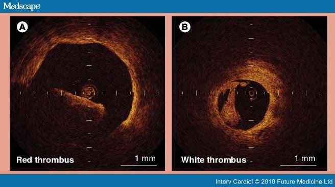 Evaluation of Stent Placement and Outcomes With OCT - Page 3