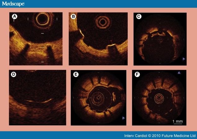 Evaluation of Stent Placement and Outcomes With OCT - Page 5