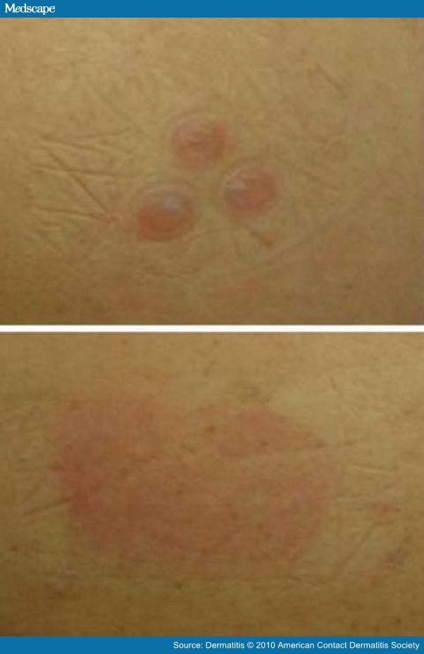 Effects of Occlusion on the Skin of Atopic Dermatitis Patients - Page 3