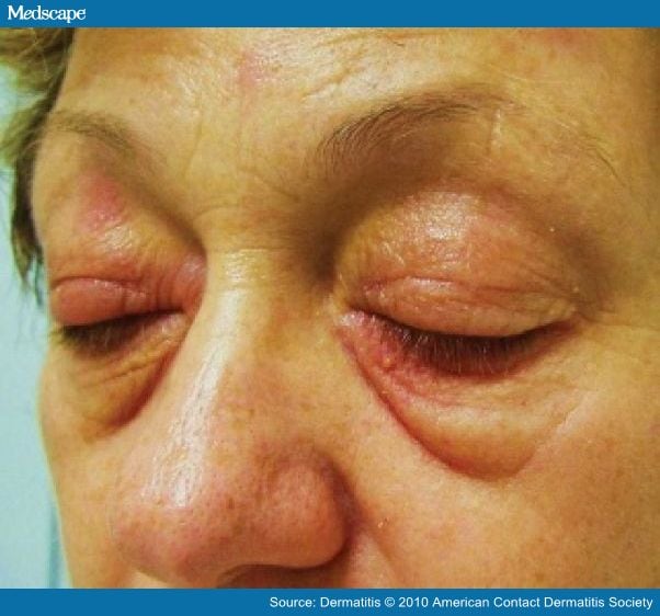 Occupational Airborne Allergic Contact Dermatitis Caused by Gold - Page 2