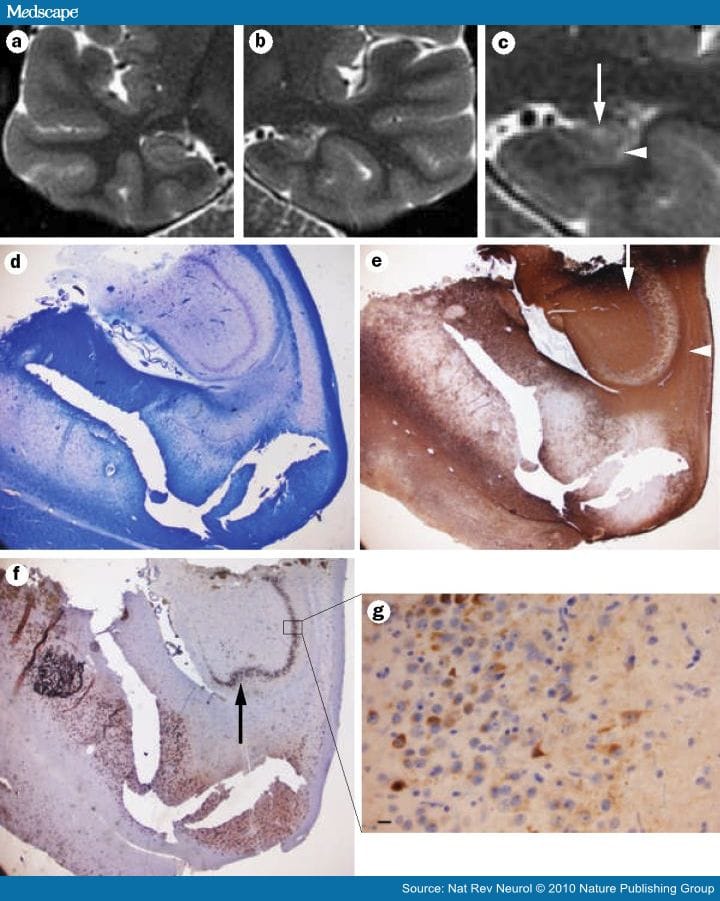 Imaging in the Surgical Treatment of Epilepsy - Page 2