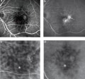 Retinal Angiomatous Proliferation: Angiographic and OCT Features