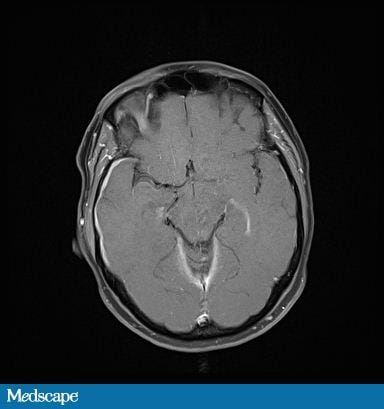 A Woman With Headache, Ocular Pain, and Meningeal Enhancement on MRI