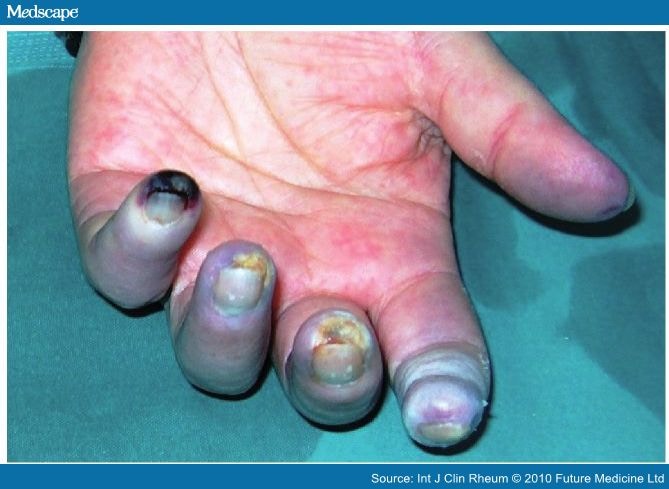 Systemic Sclerosis: Patient Subgroups and Potential Risk Factors - Page 2