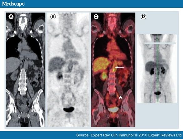 Management of Giant Cell Arteritis and Polymyalgia Rheumatica - Page 15