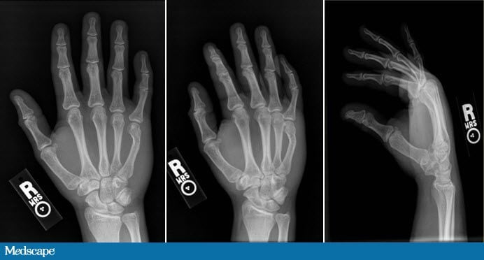 Case Report: Hand Fractures Resulting From Altercations Among Servicemen