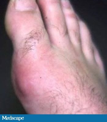 Hyperuricemia and Gout: Understanding the Drivers of Quality of Care