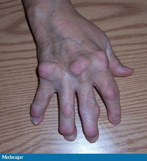 Gout and Hyperuricemia: Management in Clinical Practice