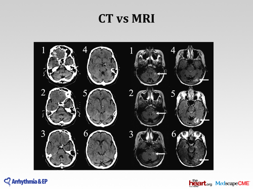 MRI-Safe Pacemakers: Should They Be Used in all Eligible Patients ...
