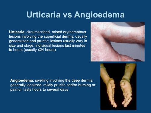 Changing Paradigms in Hereditary Angioedema: A Focus on Prompt ...
