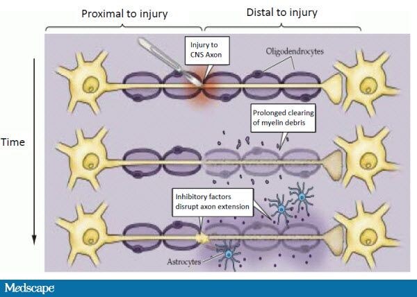 Neuropathophysiology of Multiple Sclerosis