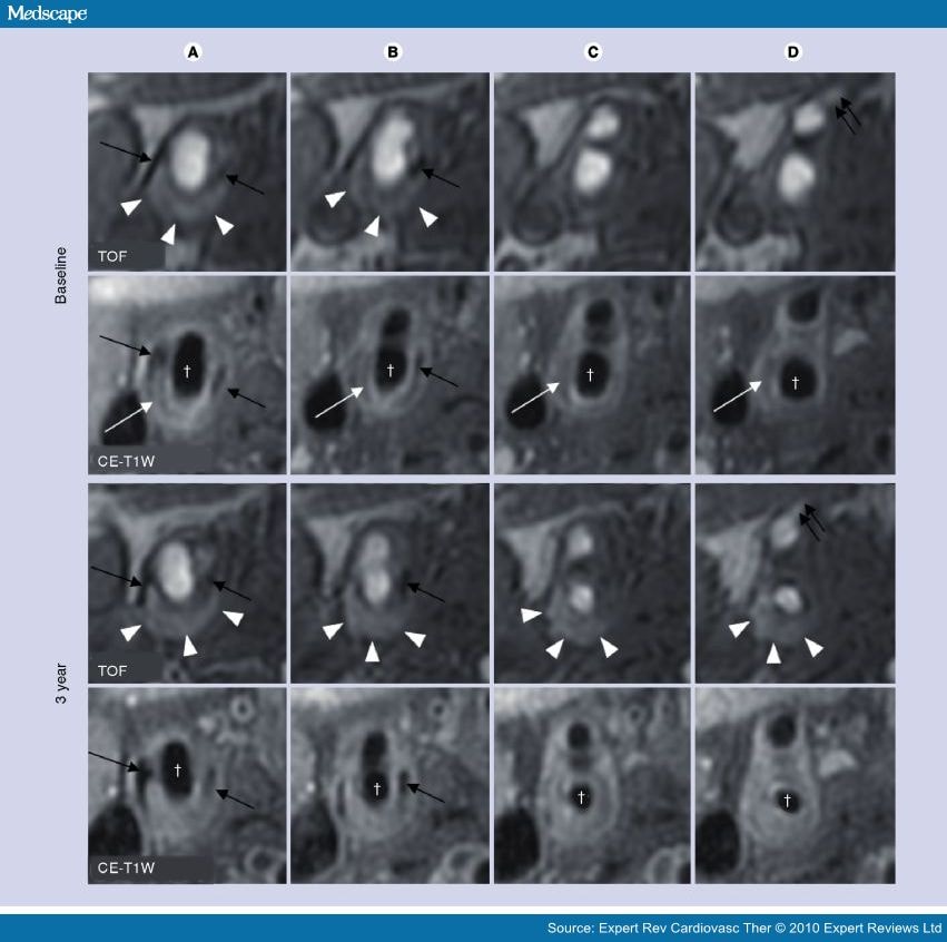 Carotid MRI: Tool for Monitoring Individual Response? - Page 2