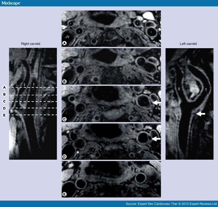 Carotid MRI: Tool for Monitoring Individual Response? - Page 6