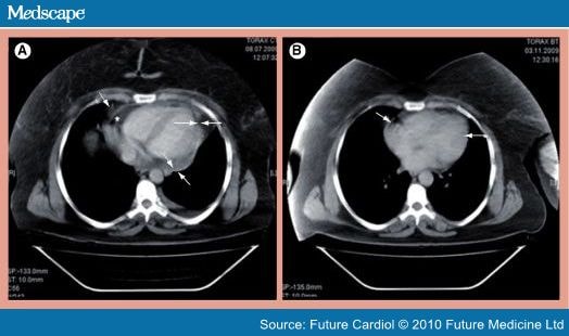 Transient Constrictive Pericarditis