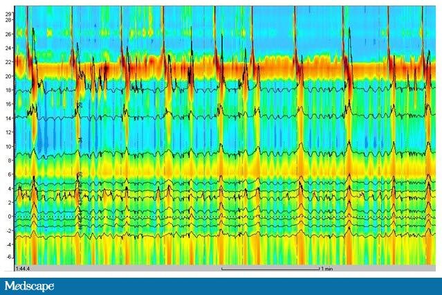 A Case of Epiphrenic Diverticulum - Page 3