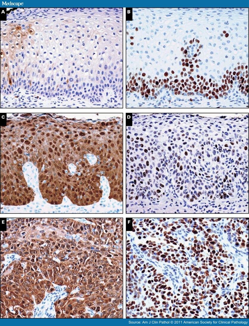 Detection of CIN and Cervical Carcinoma with p16 and ProExC