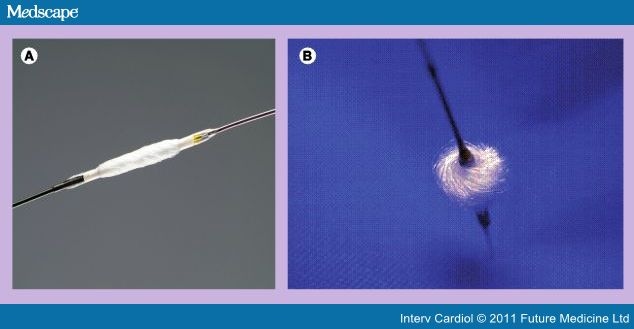 Renal Angioplasty Stenting Under Embolic Protection Device - Page 2