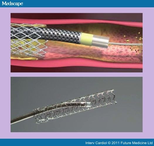 Renal Angioplasty Stenting Under Embolic Protection Device - Page 2