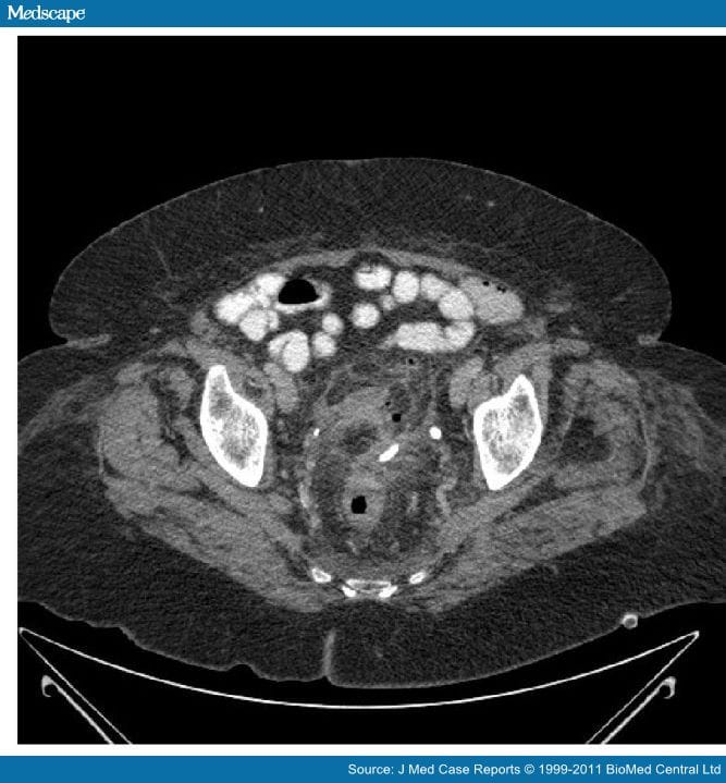 Rectal Abscess Emedicine New Guidelines For Benign Paroxysmal