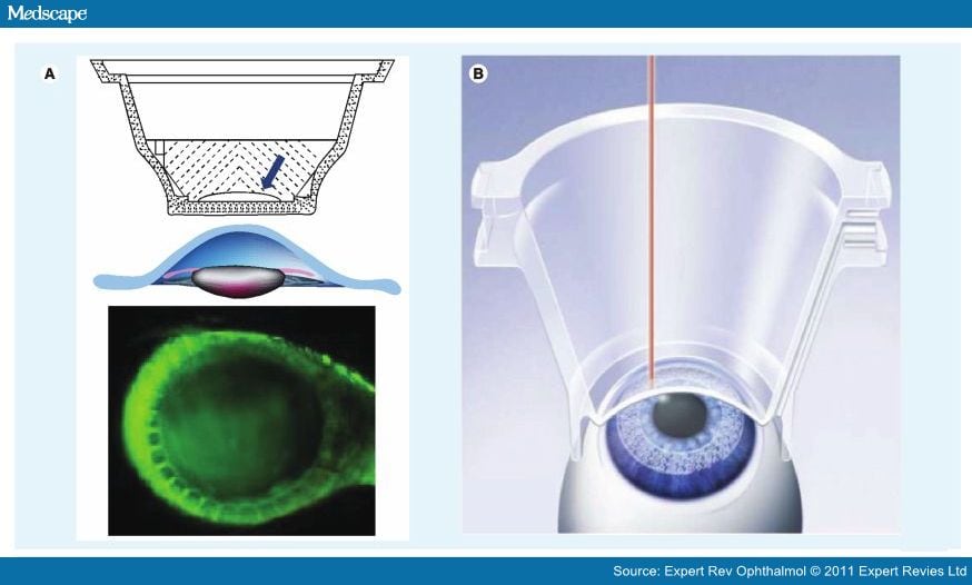 Refractive Surgery: Comparison of Femtosecond Lasers - Page 3