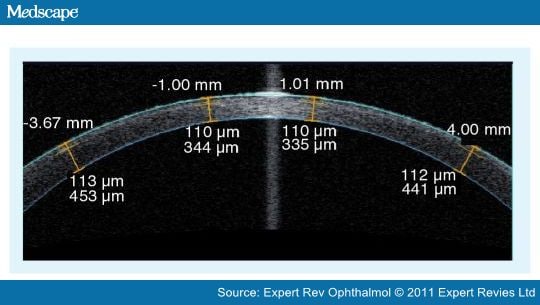 Refractive Surgery: Comparison of Femtosecond Lasers - Page 4