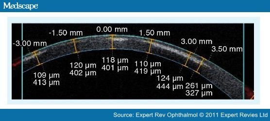Refractive Surgery: Comparison of Femtosecond Lasers - Page 5