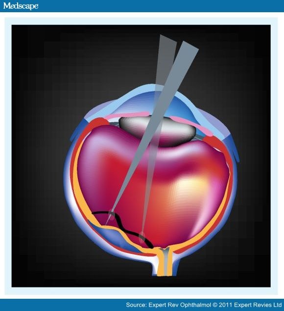 Refractive Surgery: Comparison of Femtosecond Lasers - Page 7