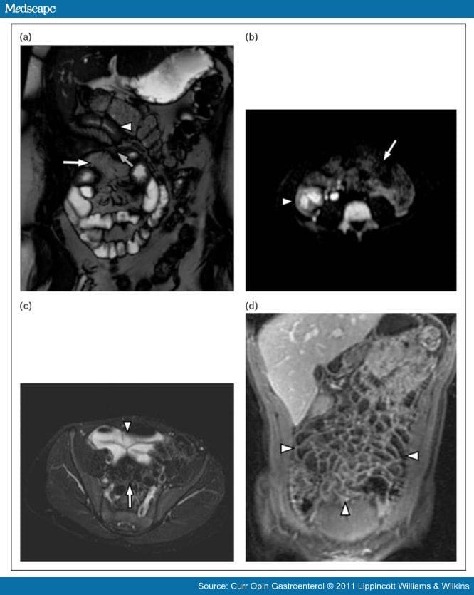 Crohn's Disease Mri Radiopaedia at Adam Ross blog