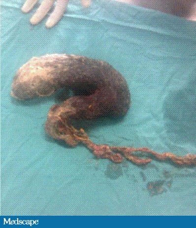 A Girl With a Gastric Trichobezoar - Page 2