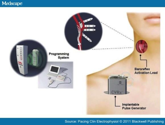 Carotid Baroreceptor Stimulators in Patients With Pacemakers and ...
