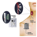 Carotid Baroreceptor Stimulators in Patients With Pacemakers and ...