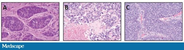 Pancreatic Endocrine Tumors: Standard of Care
