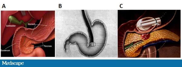 Pancreatic Endocrine Tumors: Standard of Care