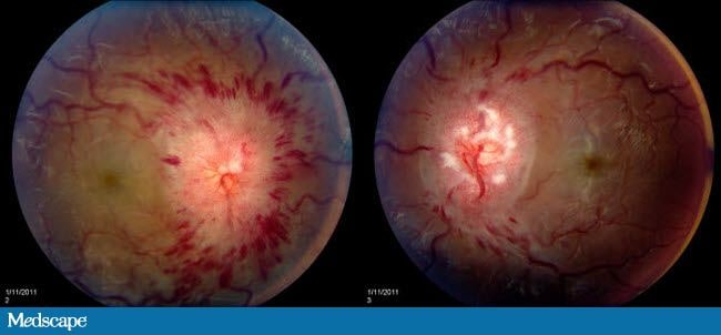 A 16-Year-Old Girl With Bilateral Optic Disc Edema