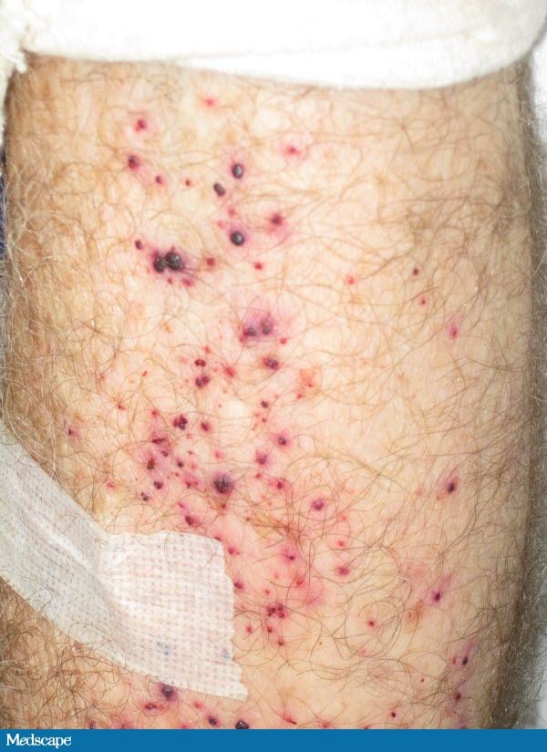 A Post-Stroke Hemorrhagic Rash