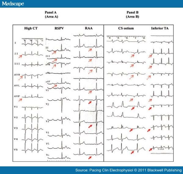 Algorithm to Predict Focal Atrial Tachycardia Site of Origin - Page 3