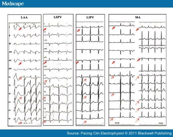 Algorithm to Predict Focal Atrial Tachycardia Site of Origin - Page 3