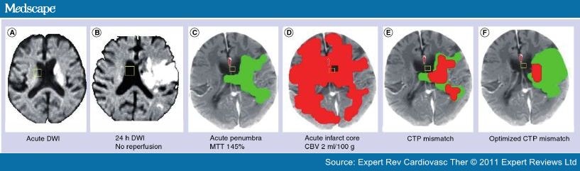 Acute Stroke Thrombolysis: Tissue-Based Decision Making - Page 7