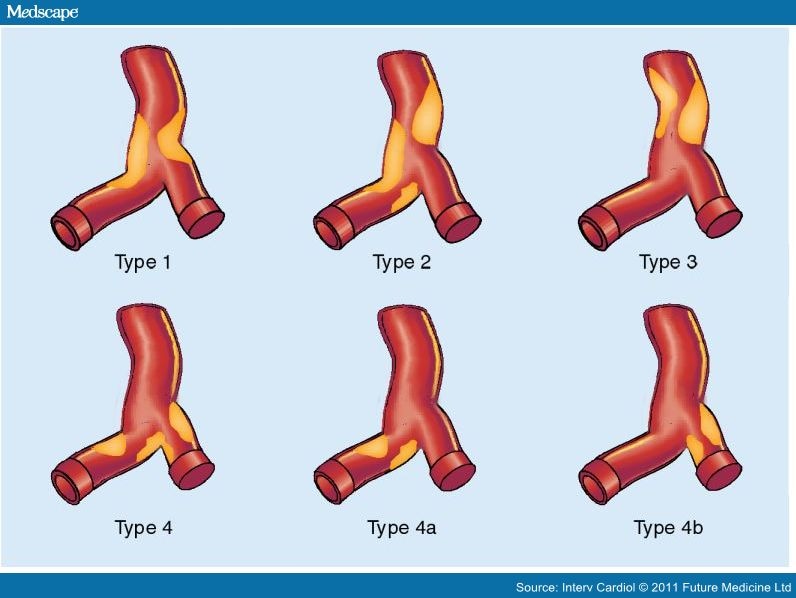 Lessons for the Treatment of Bifurcation Lesions - Page 2