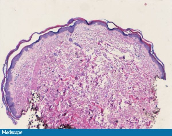 Dermatitis, Diarrhea and Alopecia: What Is Your Diagnosis? - Page 2