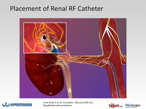Catheter-Based Renal Denervation: Current Status and Future ...