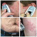 Bilateral Contact Dermatitis From the Use of Mobile Phones