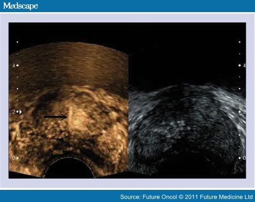 Imaging In Prostate Cancer