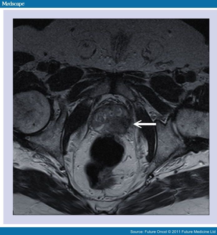 Imaging in Prostate Cancer - Page 3