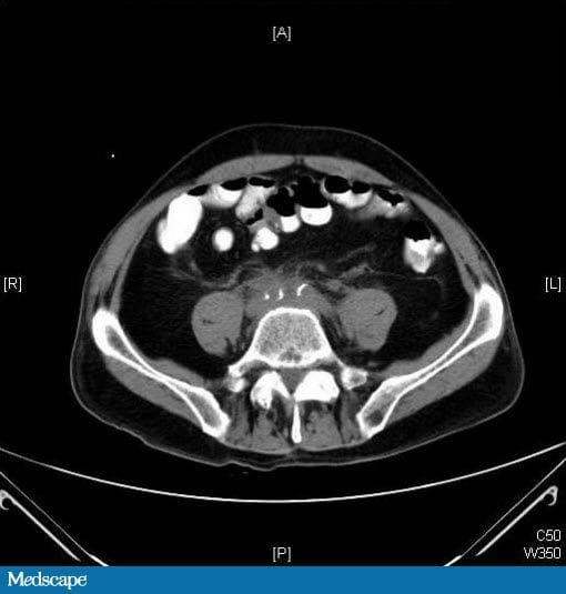 Vague Abdominal Pain and an Unusual Case of Hydronephrosis