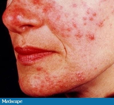 Case Studies in Rosacea: A 27-Year-Old Woman With Self-Diagnosed Acne