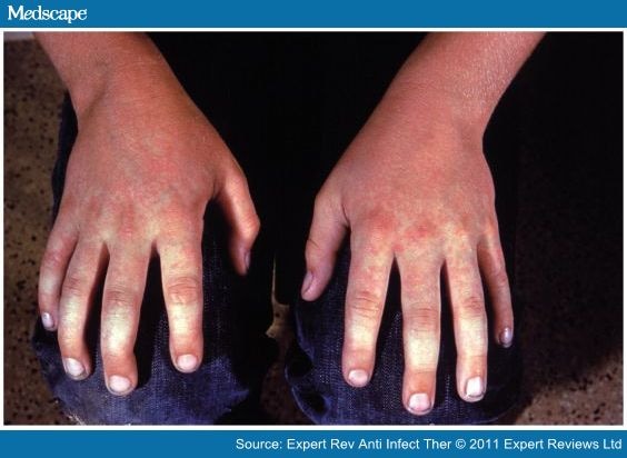 Viral Arthritides - Page 3