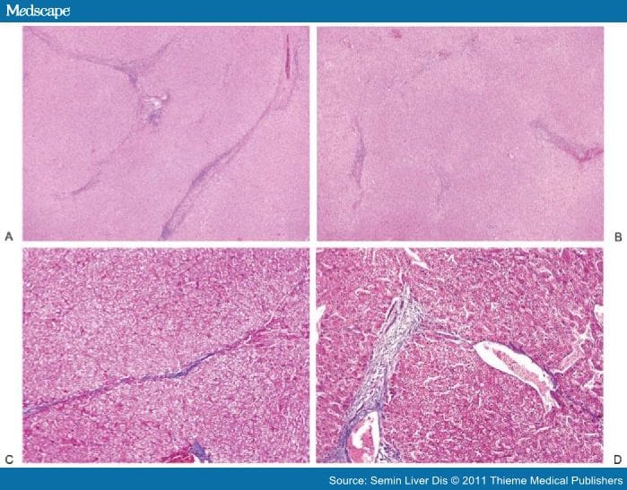 Assessment of Fibrosis and Cirrhosis in Liver Biopsies - Page 3