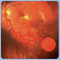 Retinal Tumors in Adults: Diagnosis and Management
