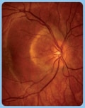Retinal Tumors in Adults: Diagnosis and Management